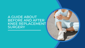 A Guide About Before And After Knee Replacement Surgery - Dr Sartawi